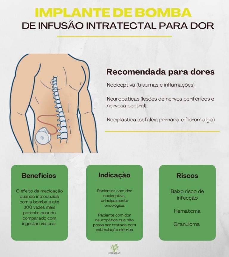 Implante de Bomba de Infusão Intratecal para Dor - Regenerati